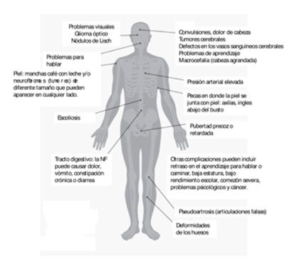 Infogen | Neurofibromatosis 1, NF-1